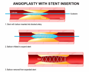 Percutaneous Coronary Artery Angioplasty Stent Procedures in ICD-10-PCS ...